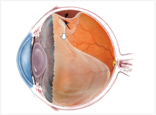 Ablatio retinae. Hoelang blijft de patiënt arbeidsongeschikt? - TBV-Online